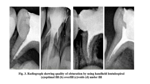 Obturation Techniques in Primary Teeth | PPTX | Dental Health ...