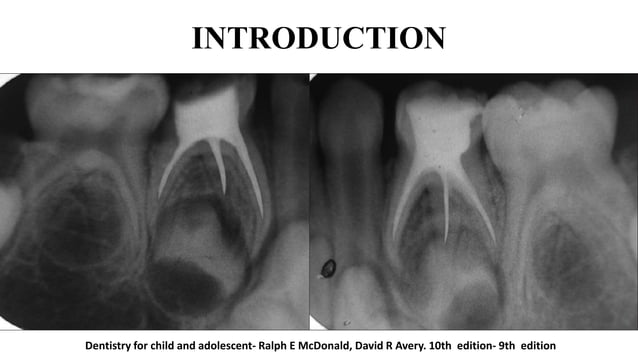 Obturation Techniques in Primary Teeth | PPTX | Dental Health ...