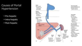 Portal Hypertension | PPTX