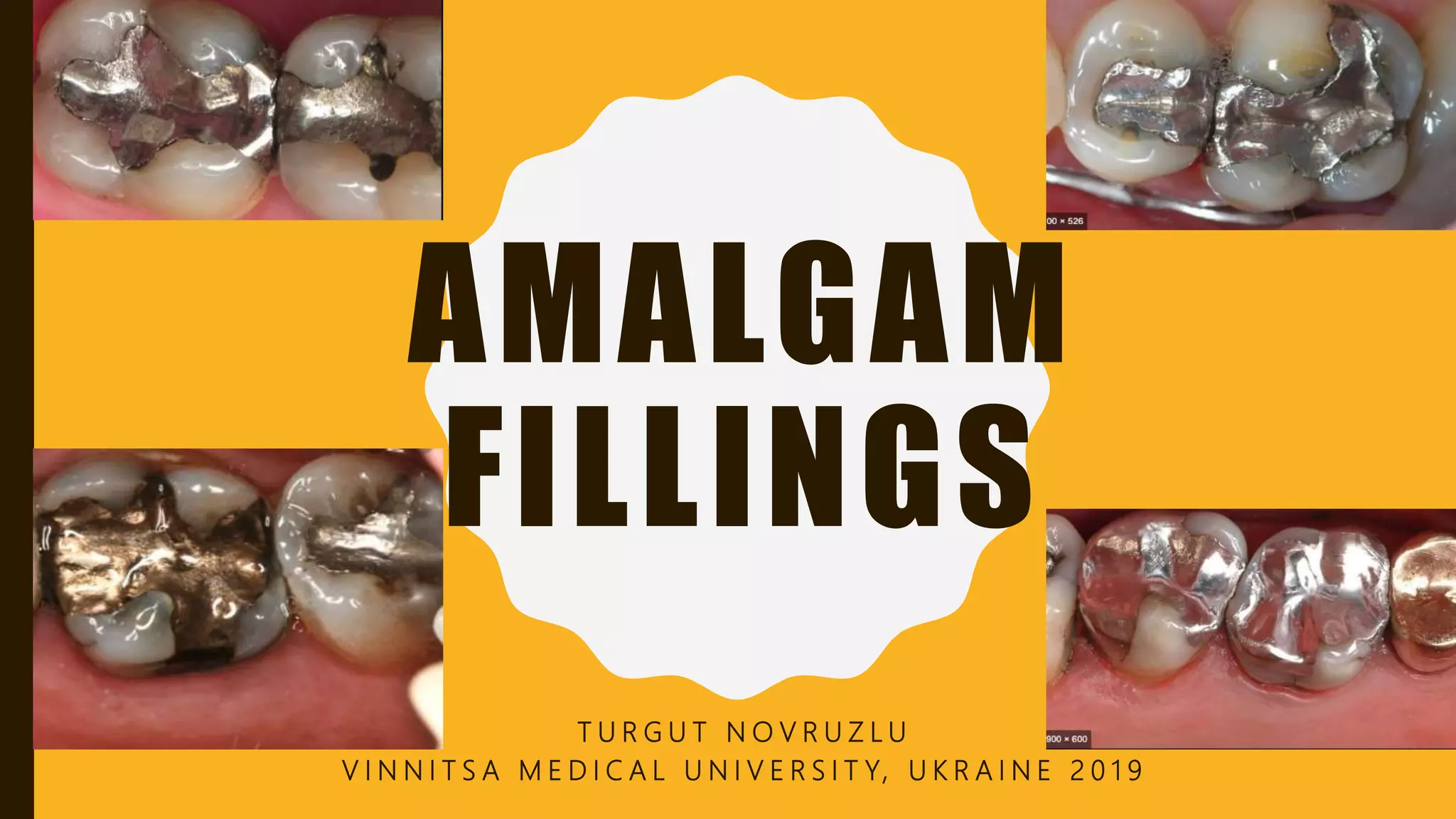 Amalgam Fillings | PPTX