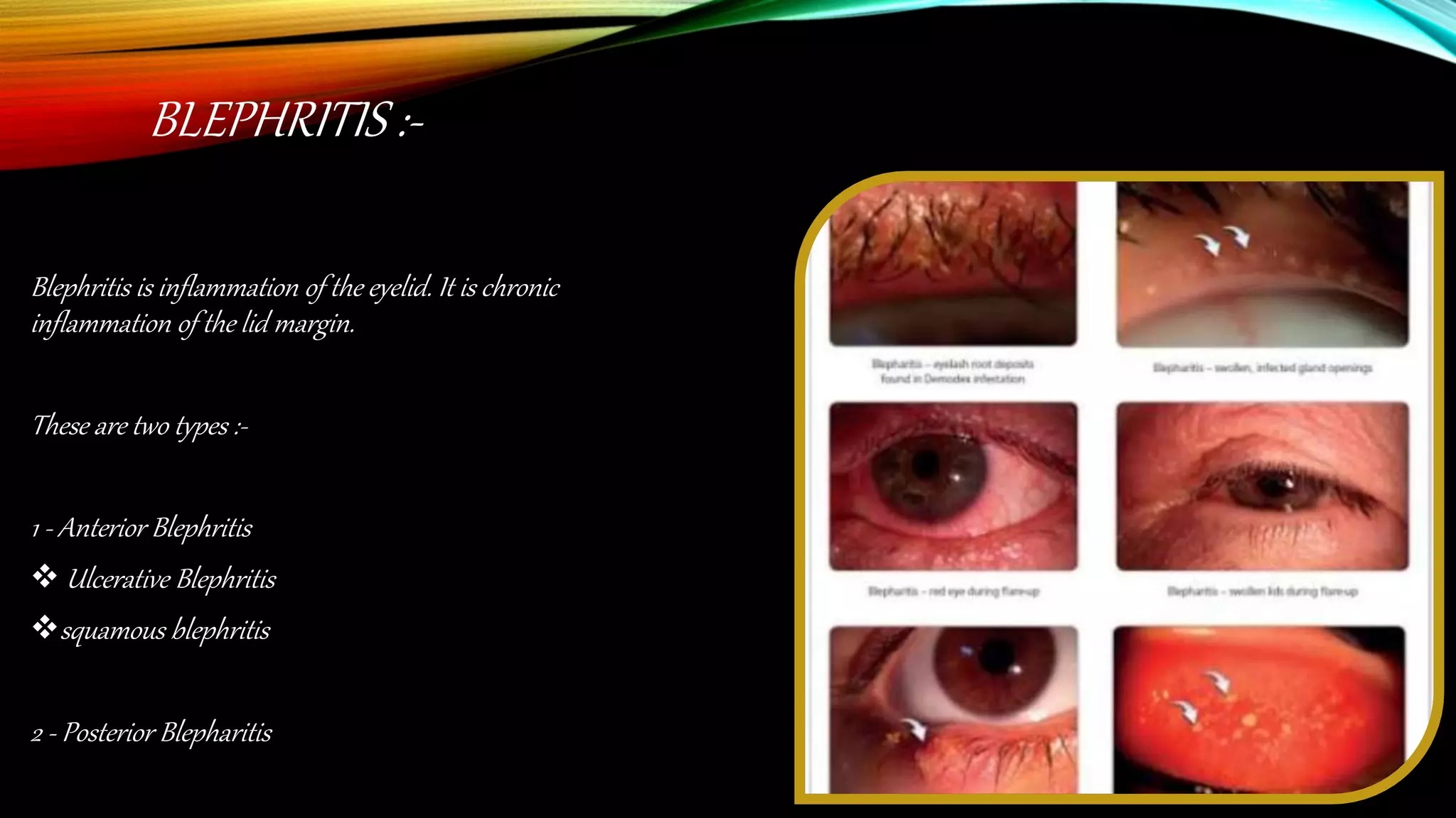 Diseases of eyelid | PPTX