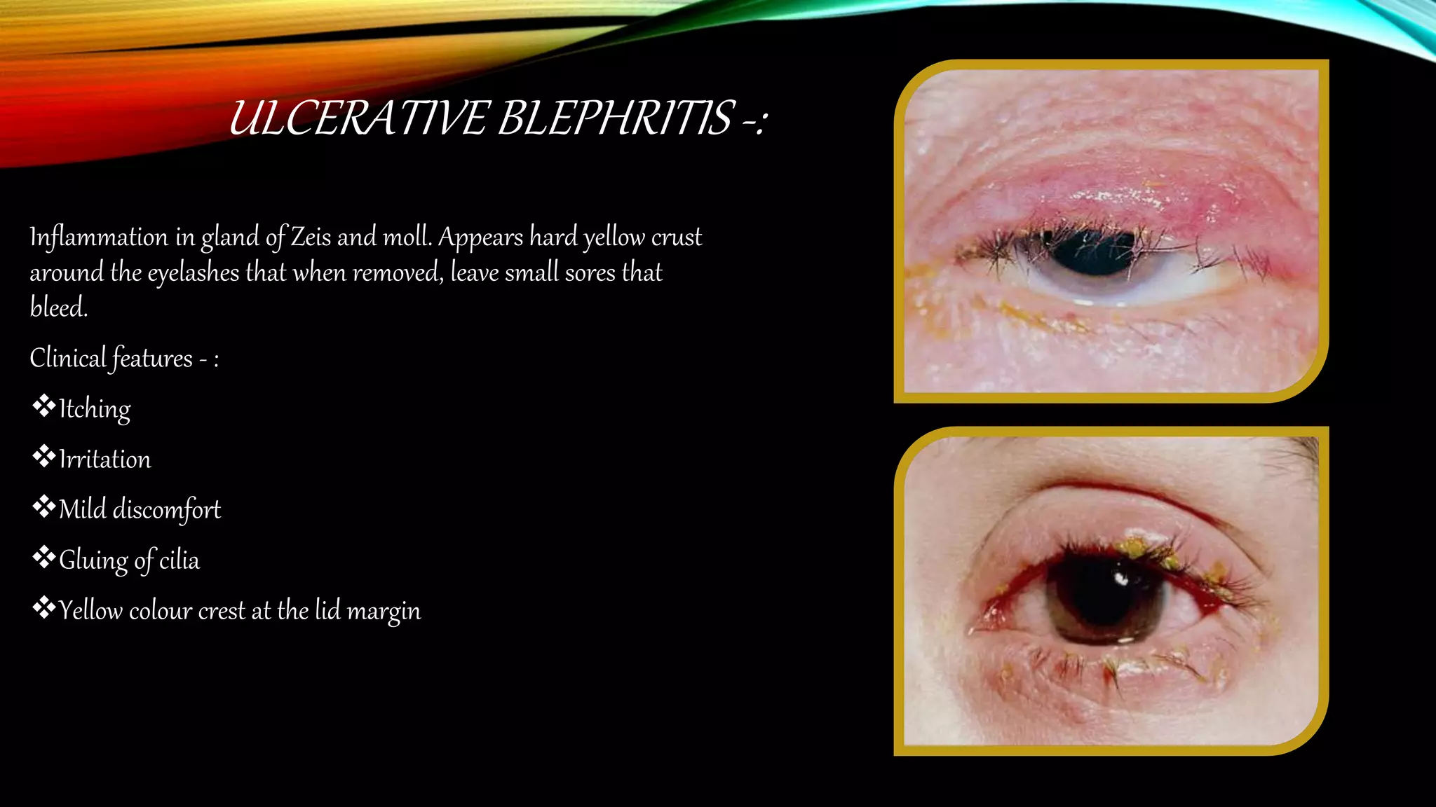Diseases of eyelid | PPTX