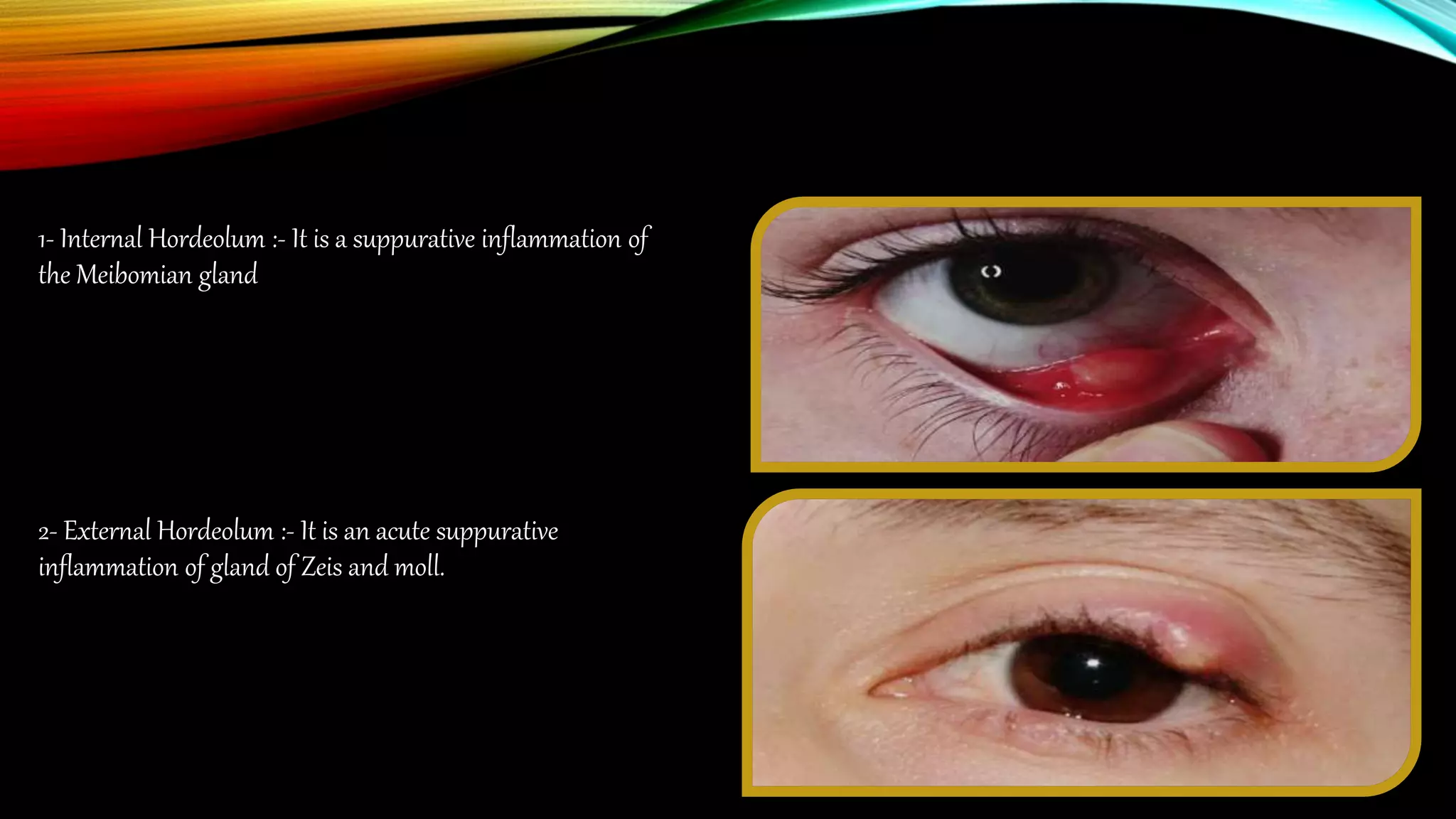 Diseases of eyelid | PPTX