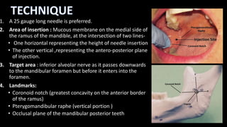 Inferior Alveolar Nerve Block | PPTX