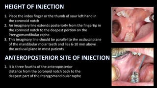 Inferior Alveolar Nerve Block | PPTX