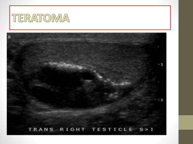 Scrotal USG | PPTX