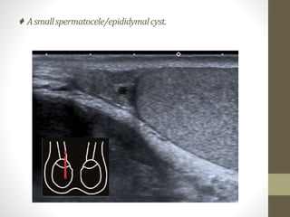 Spermatocele Ultrasound