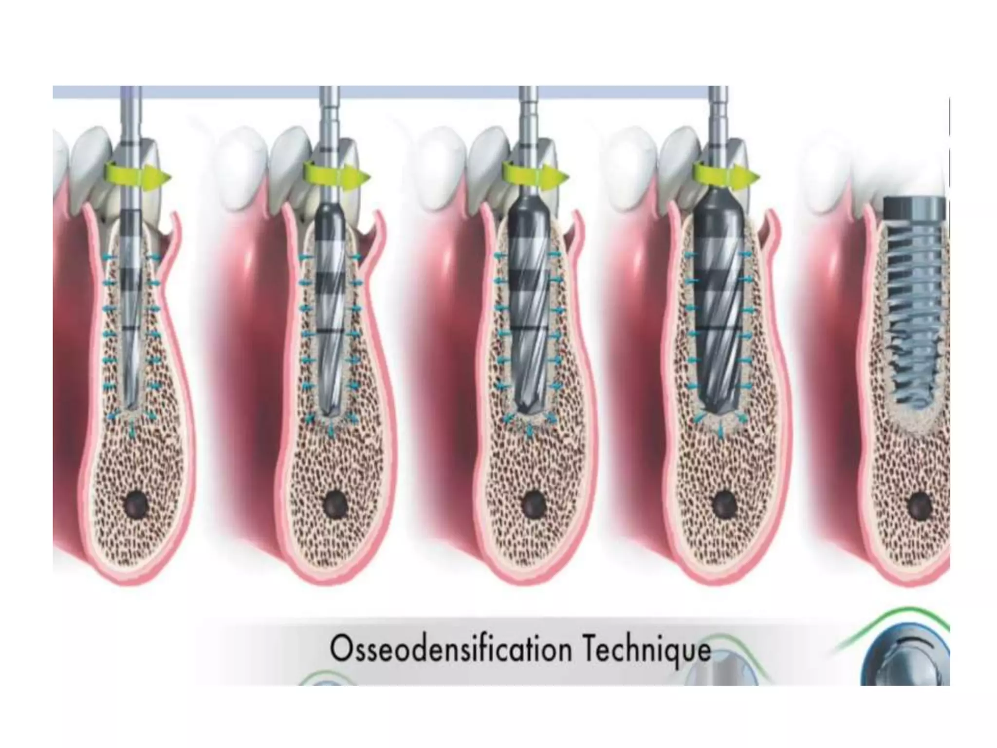 OSSEODENSIFICATION | PPTX