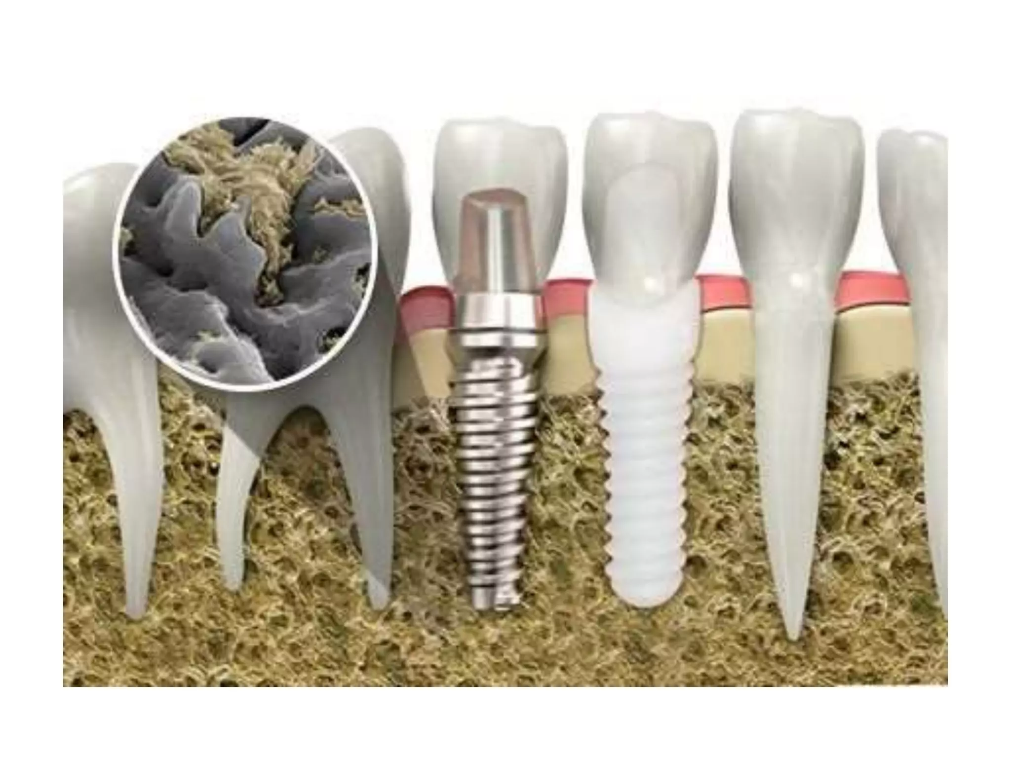 OSSEODENSIFICATION | PPTX