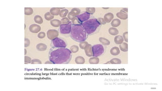 B cell disorders other than CLL | PPT