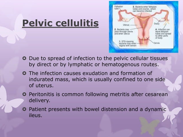 PUERPERAL SEPSIS | PPTX