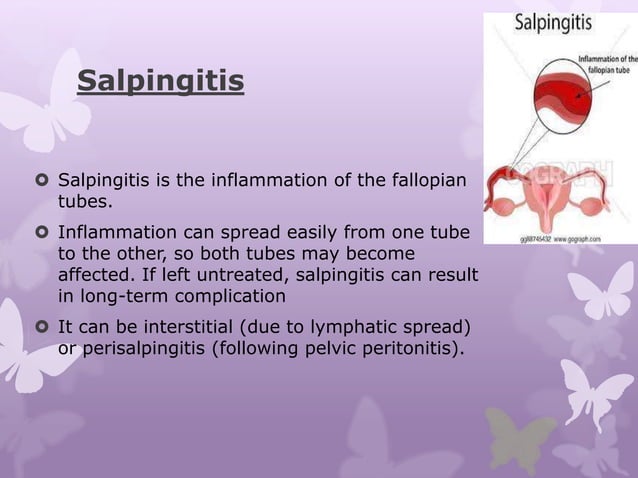 PUERPERAL SEPSIS | PPTX