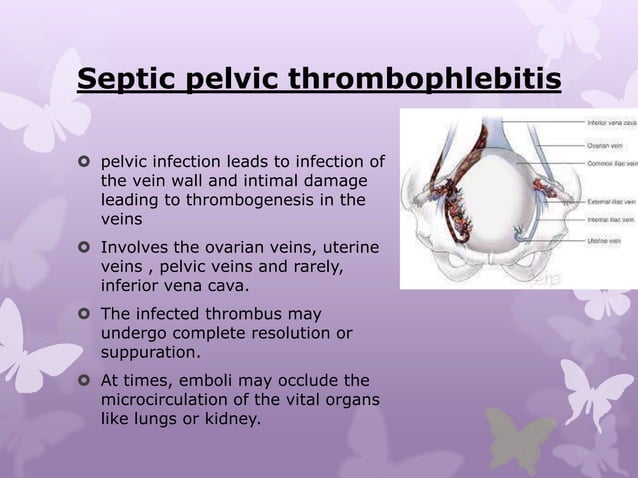 PUERPERAL SEPSIS | PPTX