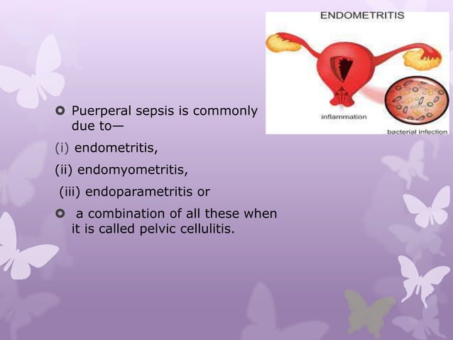 PUERPERAL SEPSIS | PPTX