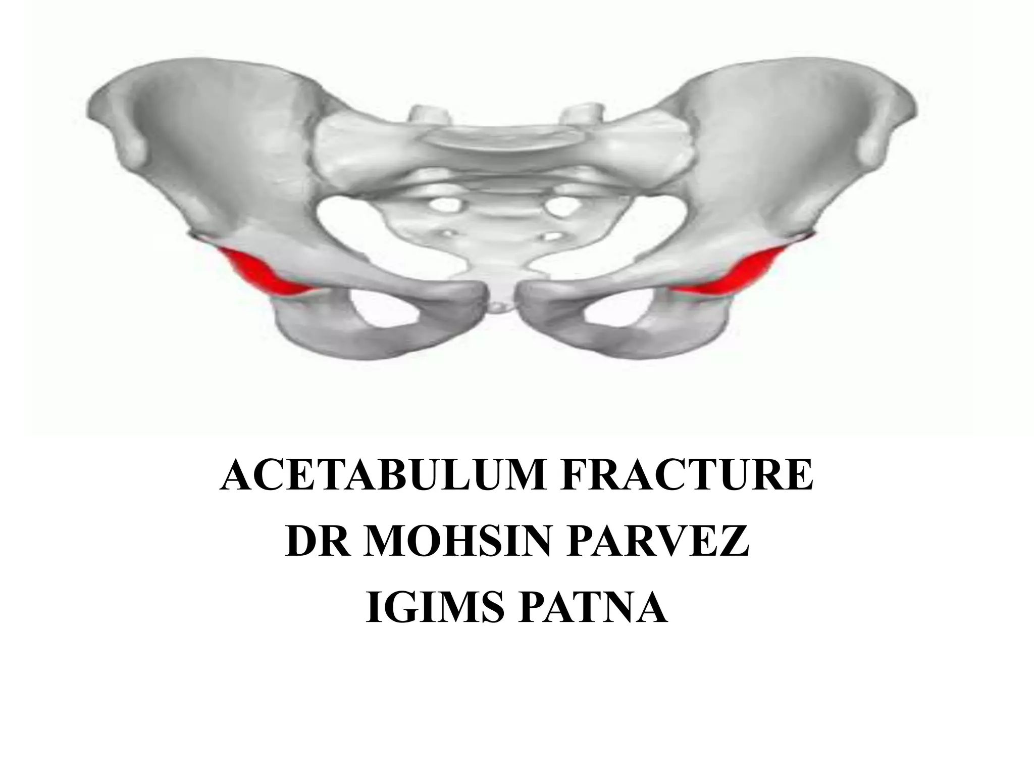 ACETABULAR FRACTURE AND MANAGEMENT | PPTX