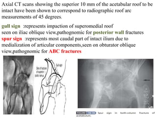 ACETABULAR FRACTURE AND MANAGEMENT | PPTX