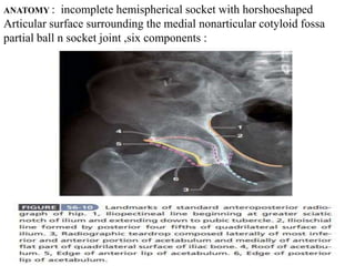 ACETABULAR FRACTURE AND MANAGEMENT | PPTX