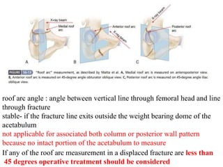 ACETABULAR FRACTURE AND MANAGEMENT | PPTX