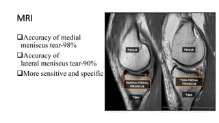 Meniscus injury for postgraduate | PPTX