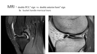 Meniscus injury for postgraduate | PPTX