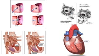 pulmonary hypertension with CHD.pptx
