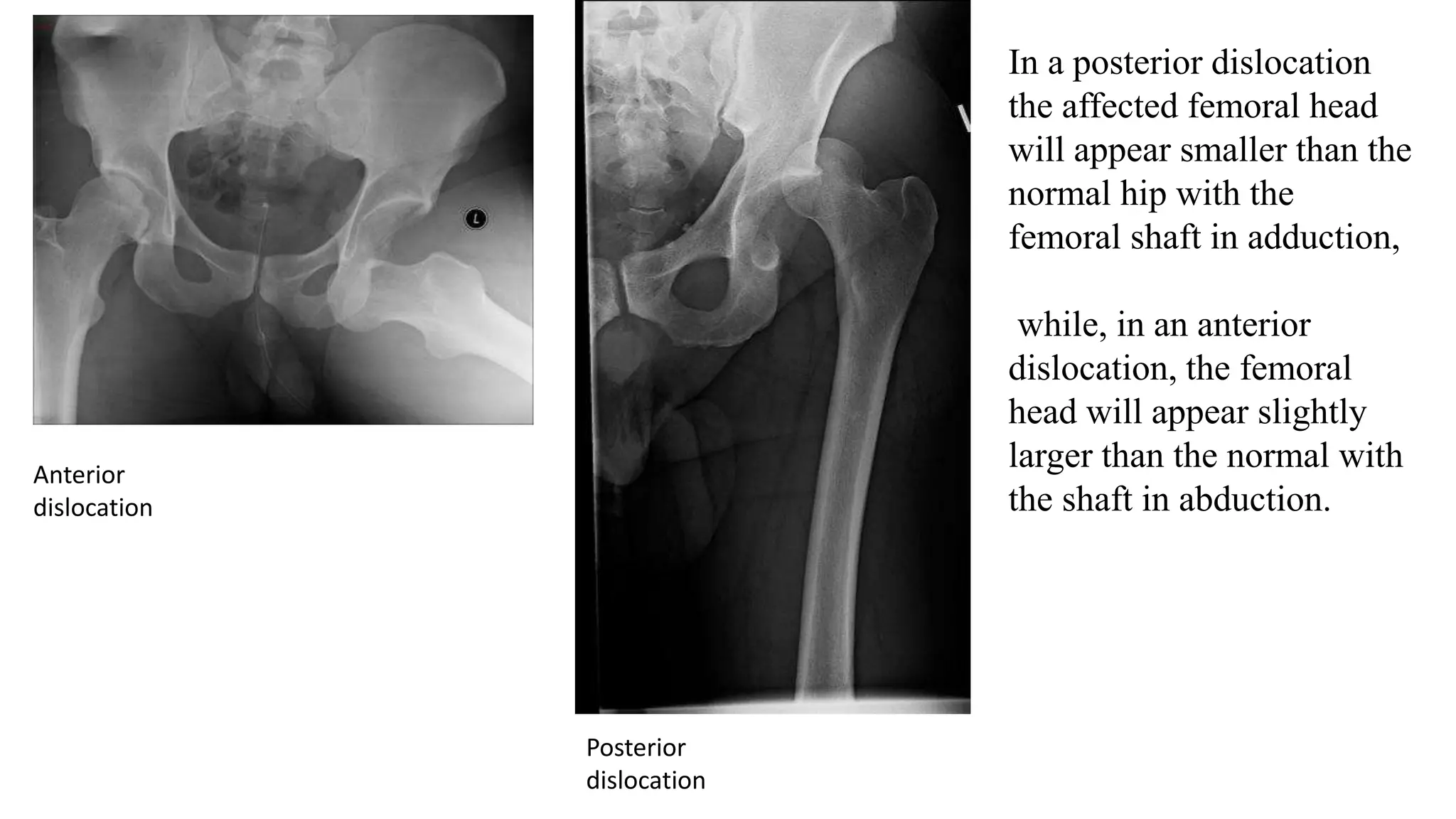 Hip Dislocation | PPTX