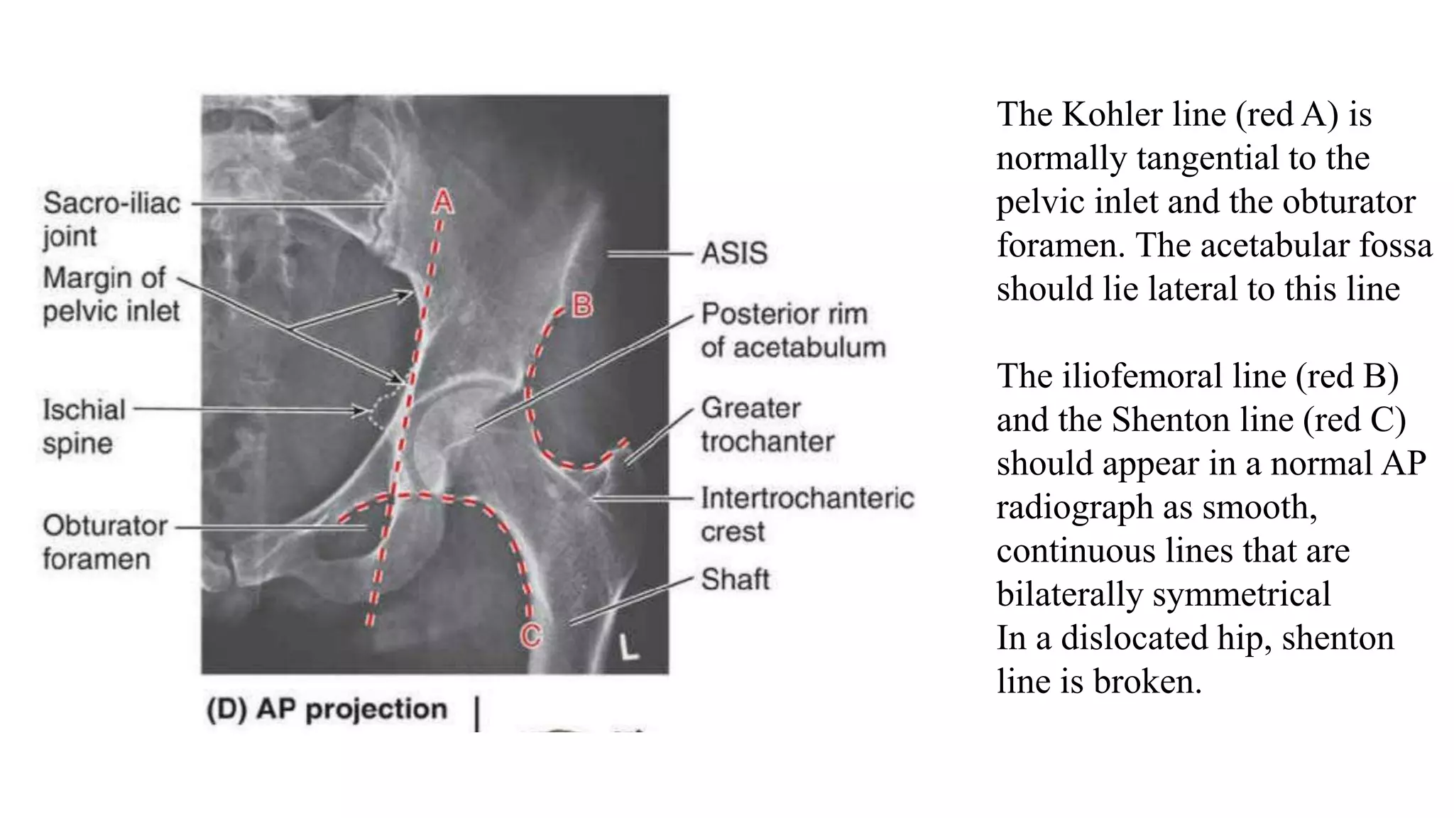 Hip Dislocation | PPTX