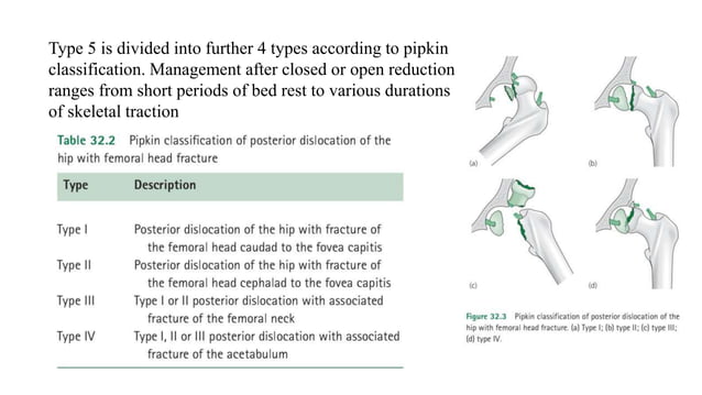 Hip Dislocation | PPTX