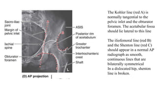 Hip Dislocation | PPTX