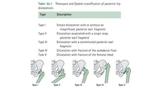 Hip Dislocation | PPTX