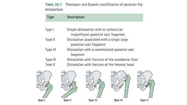 Hip Dislocation Ppt
