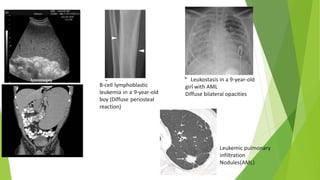 pediatric malignancy | PPTX