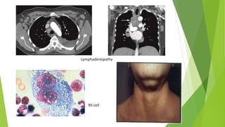 pediatric malignancy | PPTX