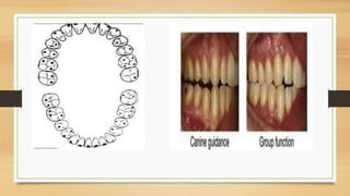occlusal adjustment | PPTX