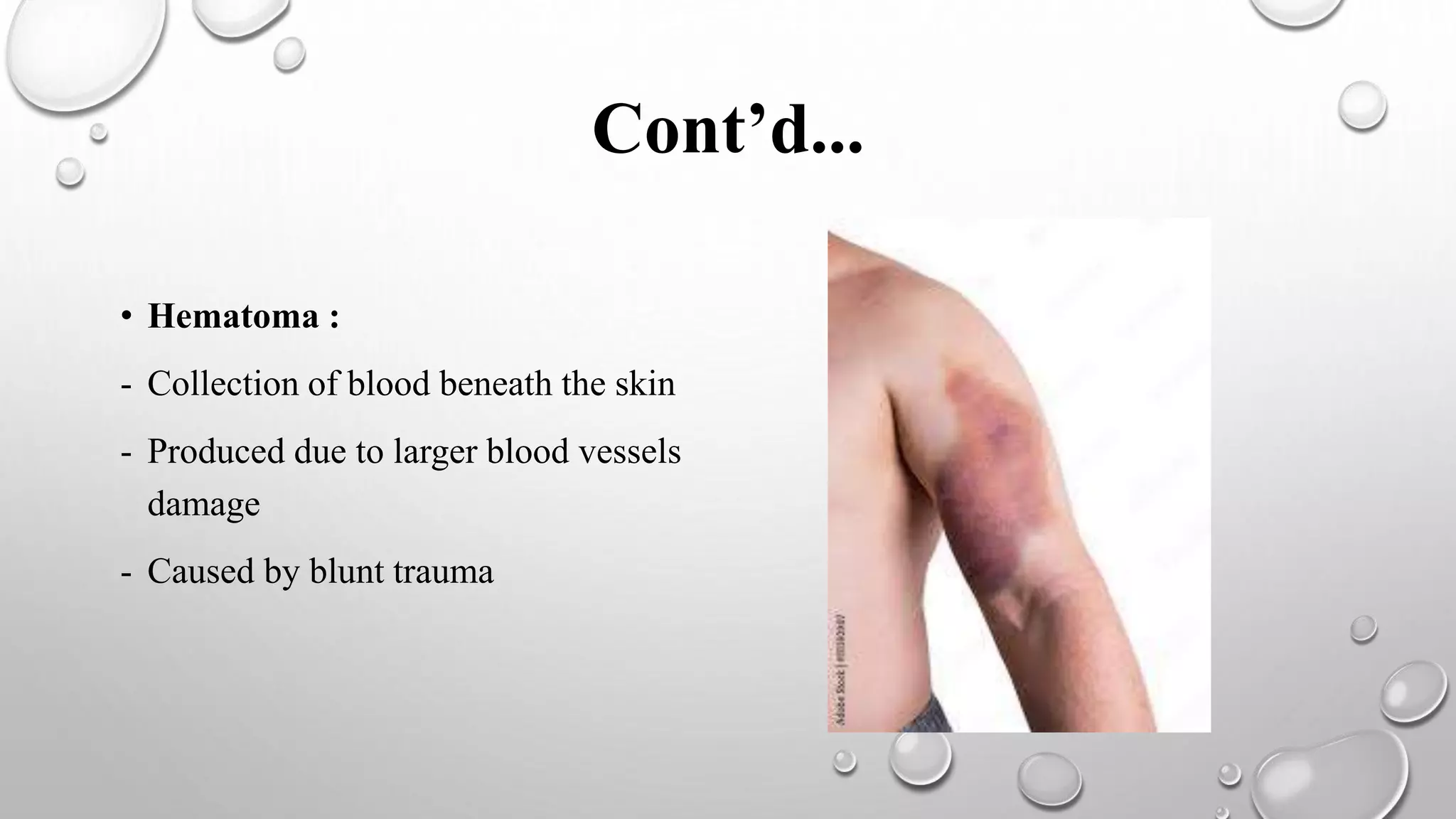 Management of soft tissue injury | PPTX