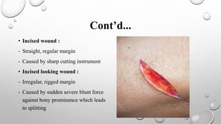 Management of soft tissue injury | PPTX