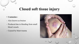 Management of soft tissue injury | PPTX