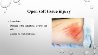 Management of soft tissue injury | PPTX