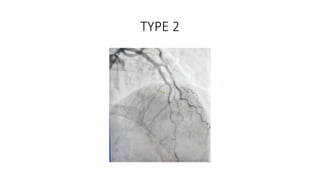 coronary artery dissection | PPTX