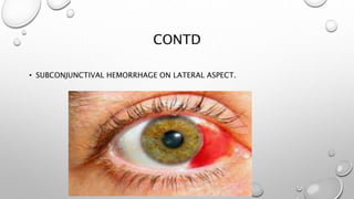 ZMC FRACTURE / zygomatico maxillary complex fracture. fracture | PPT