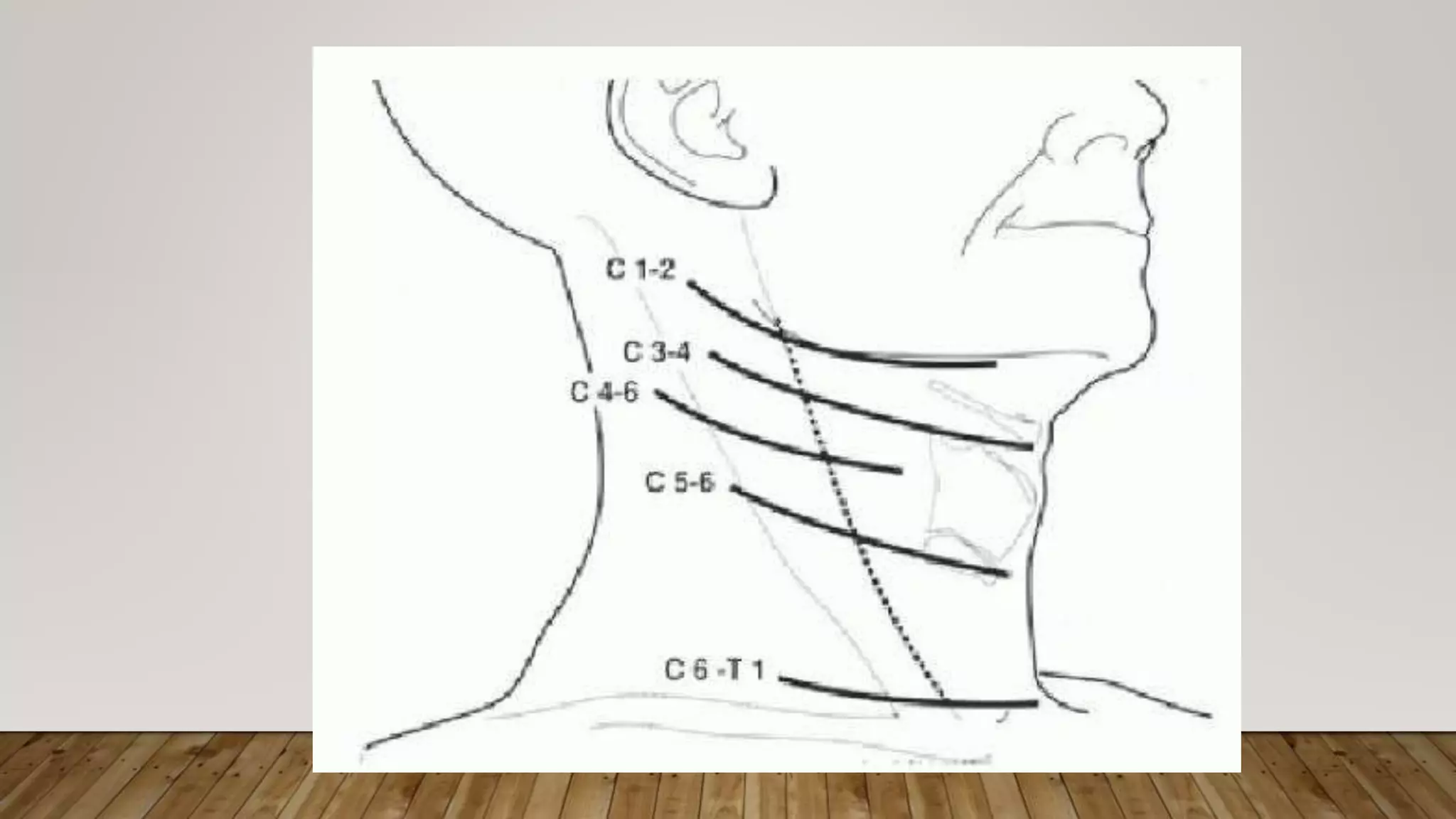 Anterior Cervical Corpectomy | PPTX