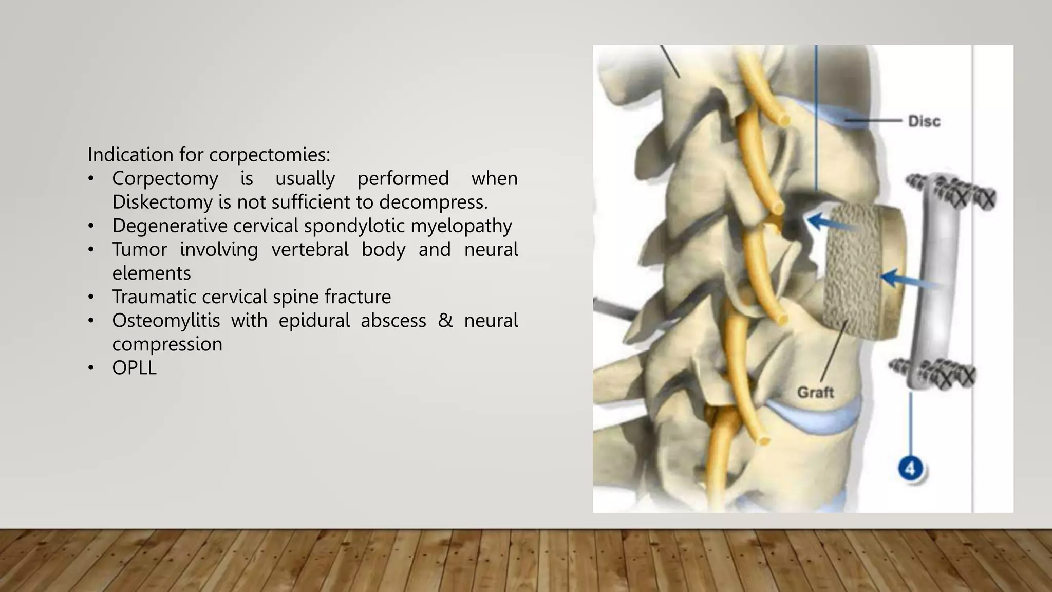Anterior Cervical Corpectomy | PPTX
