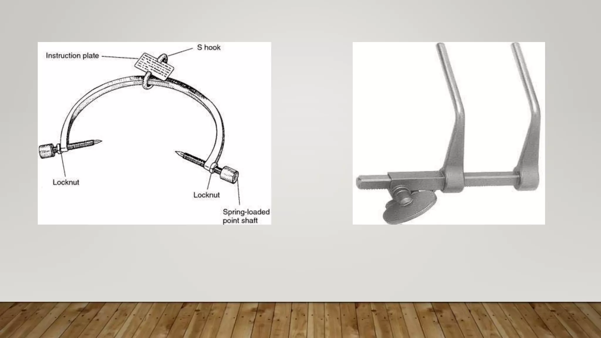 Anterior Cervical Corpectomy | PPTX