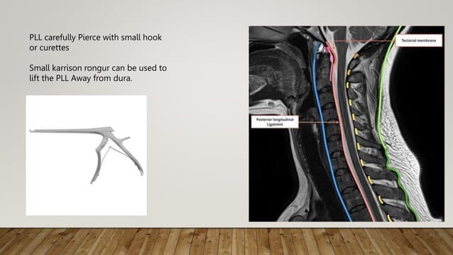 Anterior Cervical Corpectomy | PPT