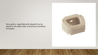 Anterior Cervical Corpectomy | PPTX