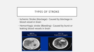 Stroke Awareness | PPTX