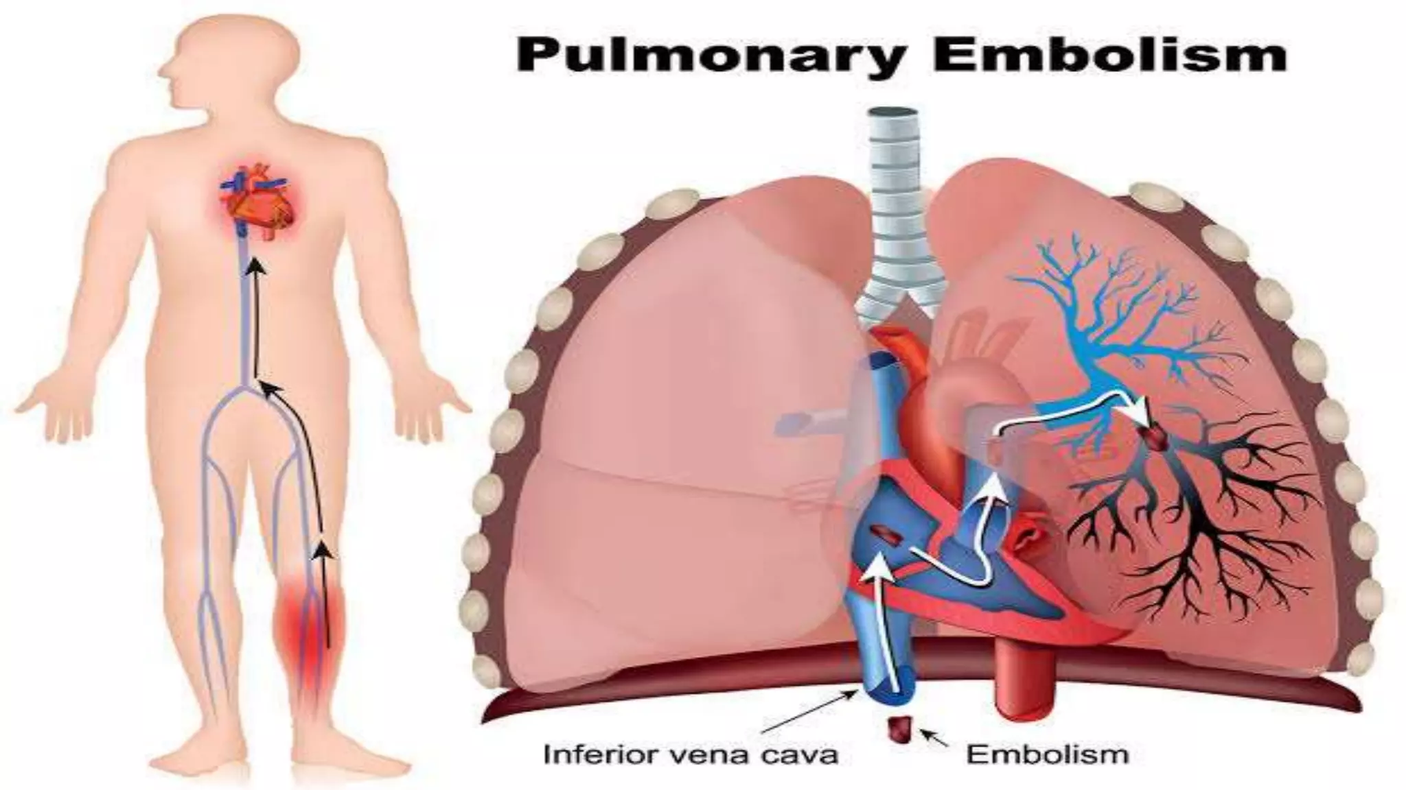 Pulmonary embolism | PPTX