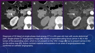 Dual Energy CT in evaluation of gastrointestinal bleed | PPTX