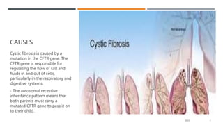 Cystic Fibrosis.pptx