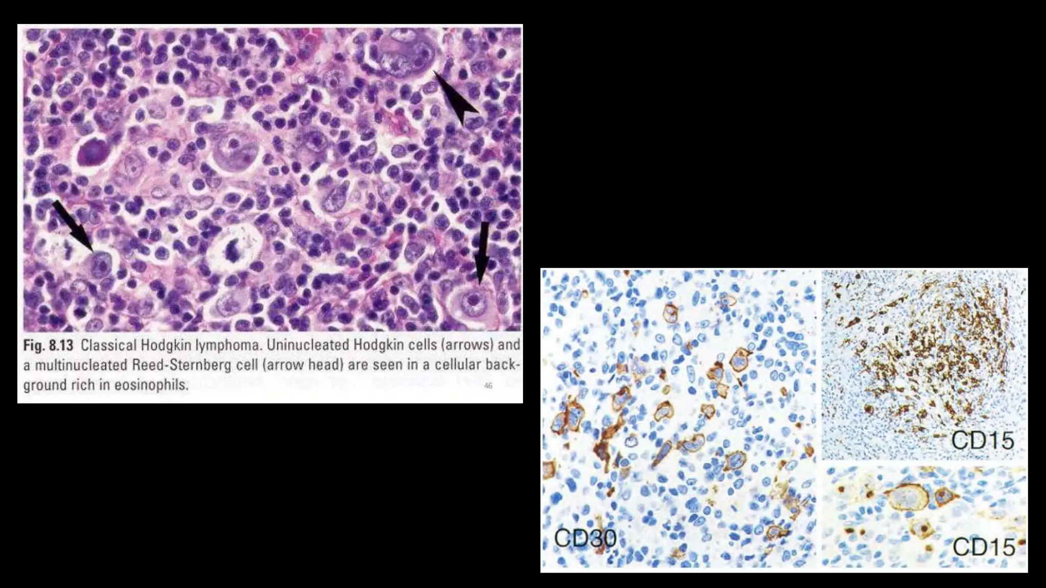 ROUND CELL TUMOR.pptx